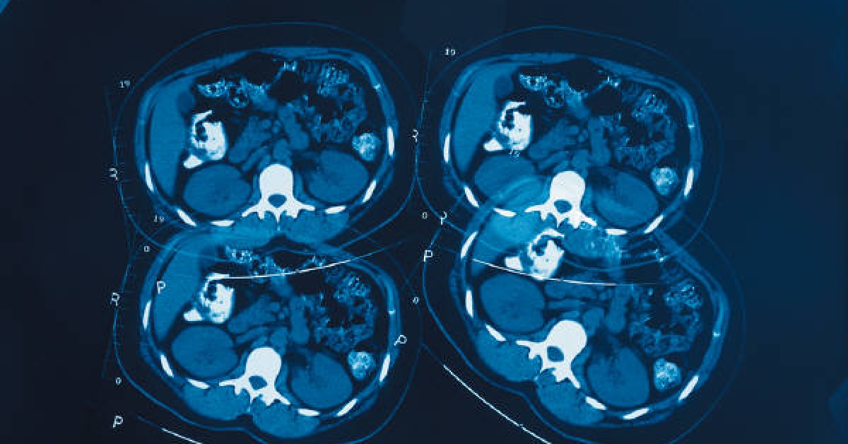 Coronary Clot Aspiration Safe Long Term | RxWiki