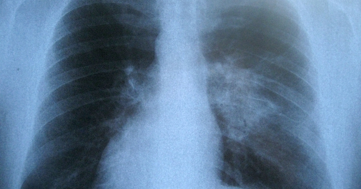Better Scope for Lung Disease Diagnosis | RxWiki