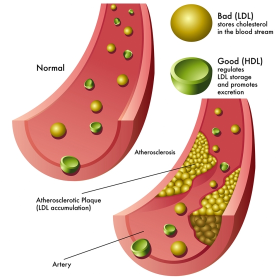 Cholesterol 101 What Is Good Vs Bad Cholesterol RxWiki cholesterol-101-what-is-good-vs-bad-cholesterol-rxwiki